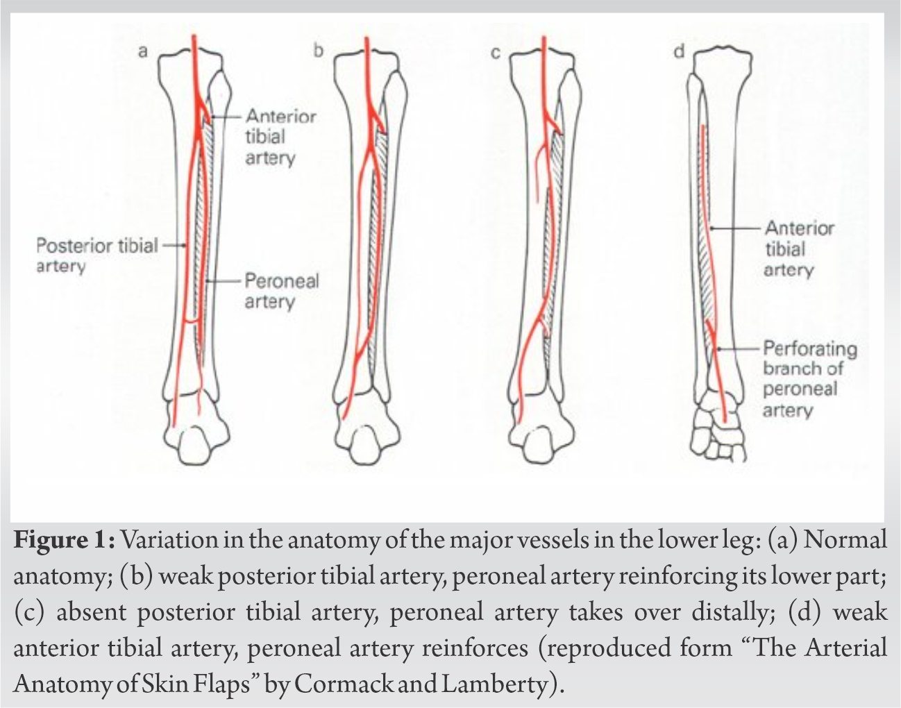 The “Lost” Peroneal Vessel – A Rare Anatomical Variation in Free Fibula ...