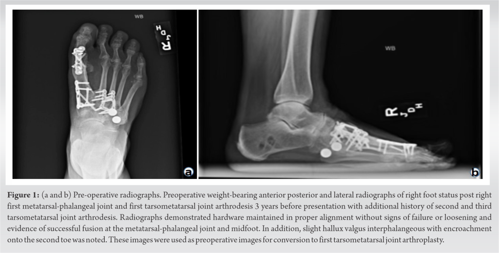 Conversion of First Metatarsal-Phalangeal Joint Arthrodesis to ...