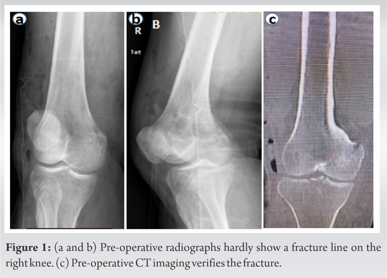 Bilateral Hoffa Fractures of the Medial Femoral Condyles: A Case Report ...