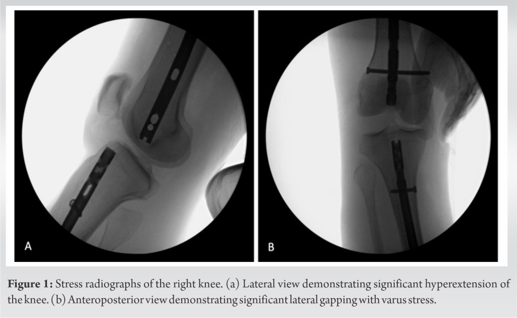 Multiligament Knee Reconstruction of the ACL, PLC, and ALL in a ...