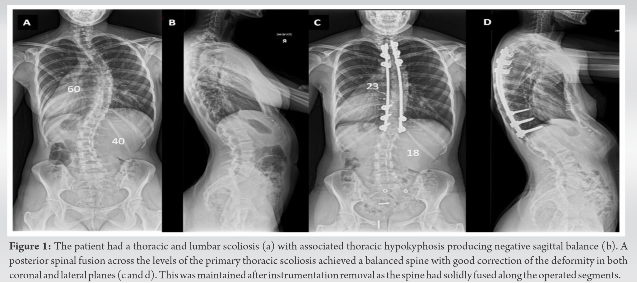 Management of a periaortic spinal pedicle screw in a patient with adult ...