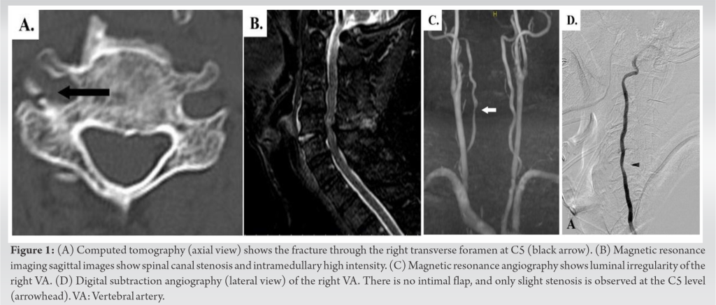 Coil Embolization for Asymptomatic Low-grade Vertebral Artery Injury ...