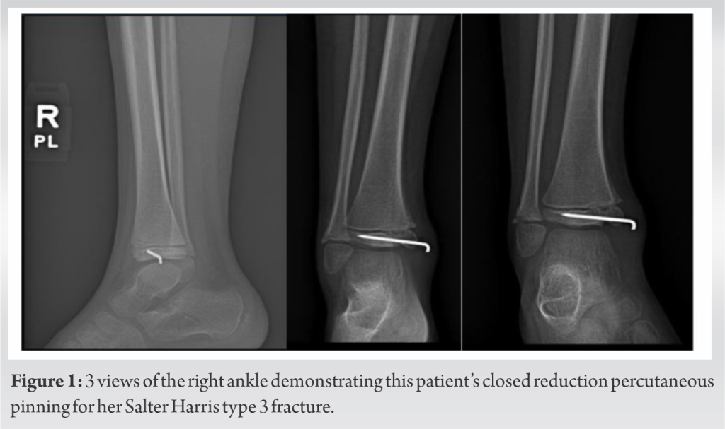 Spontaneous Resolution of Pediatric Varus Ankle Deformity: A Case ...