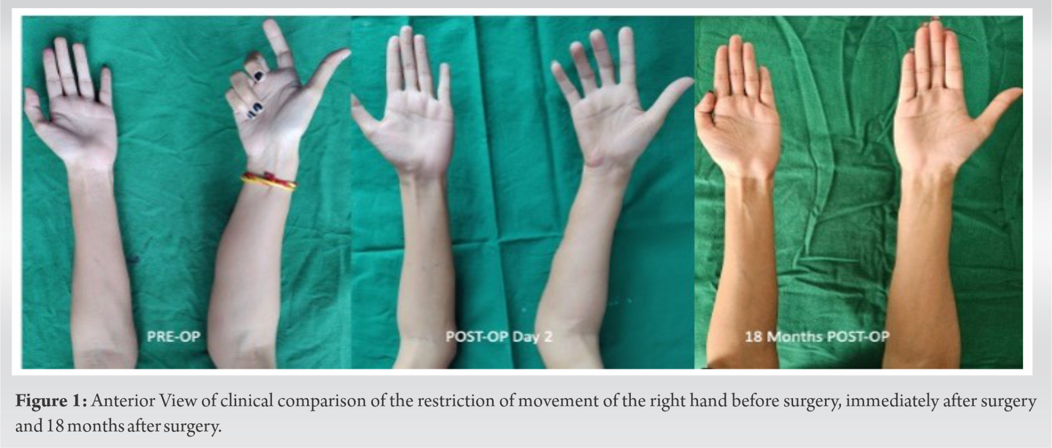 Pseudotumor – Cysticercosis of the Flexor Digitorum Profundus Mimicking ...