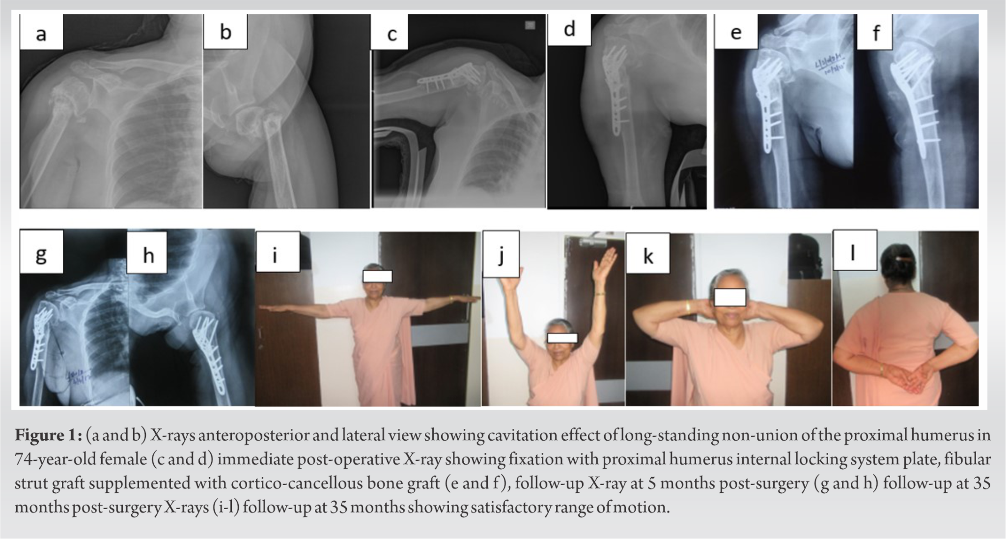 Outcome of Osteosynthesis of Late-Presenting Proximal Humerus Non-union ...