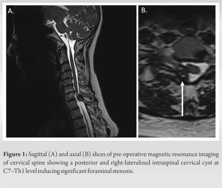 Intraspinal Extradural Degenerative Cervical Cyst Treated by Anterior ...
