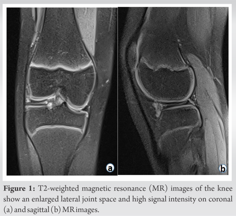 Discoid Double-layered Lateral Meniscus: A Case Report | Journal of ...