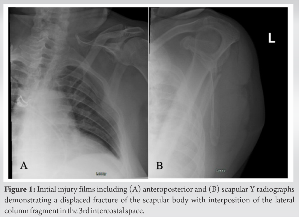 A Broken Shoulder Scapula Fracture