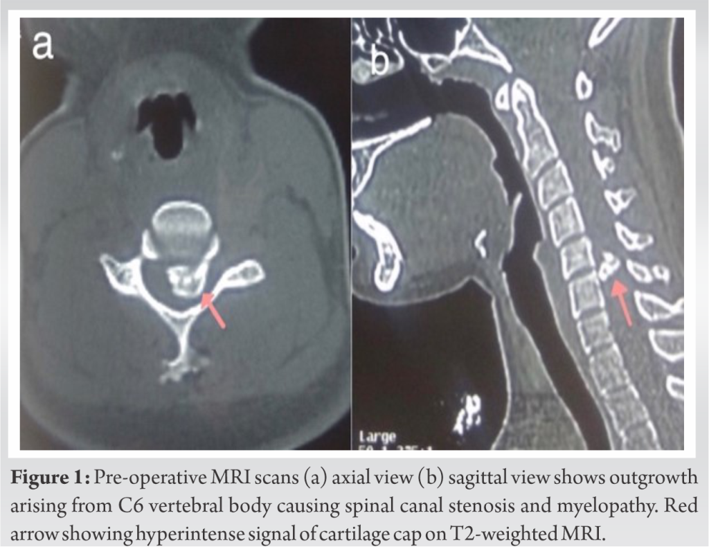 A Unique Presentation of Vertebral Body Osteochondroma of Sixth ...