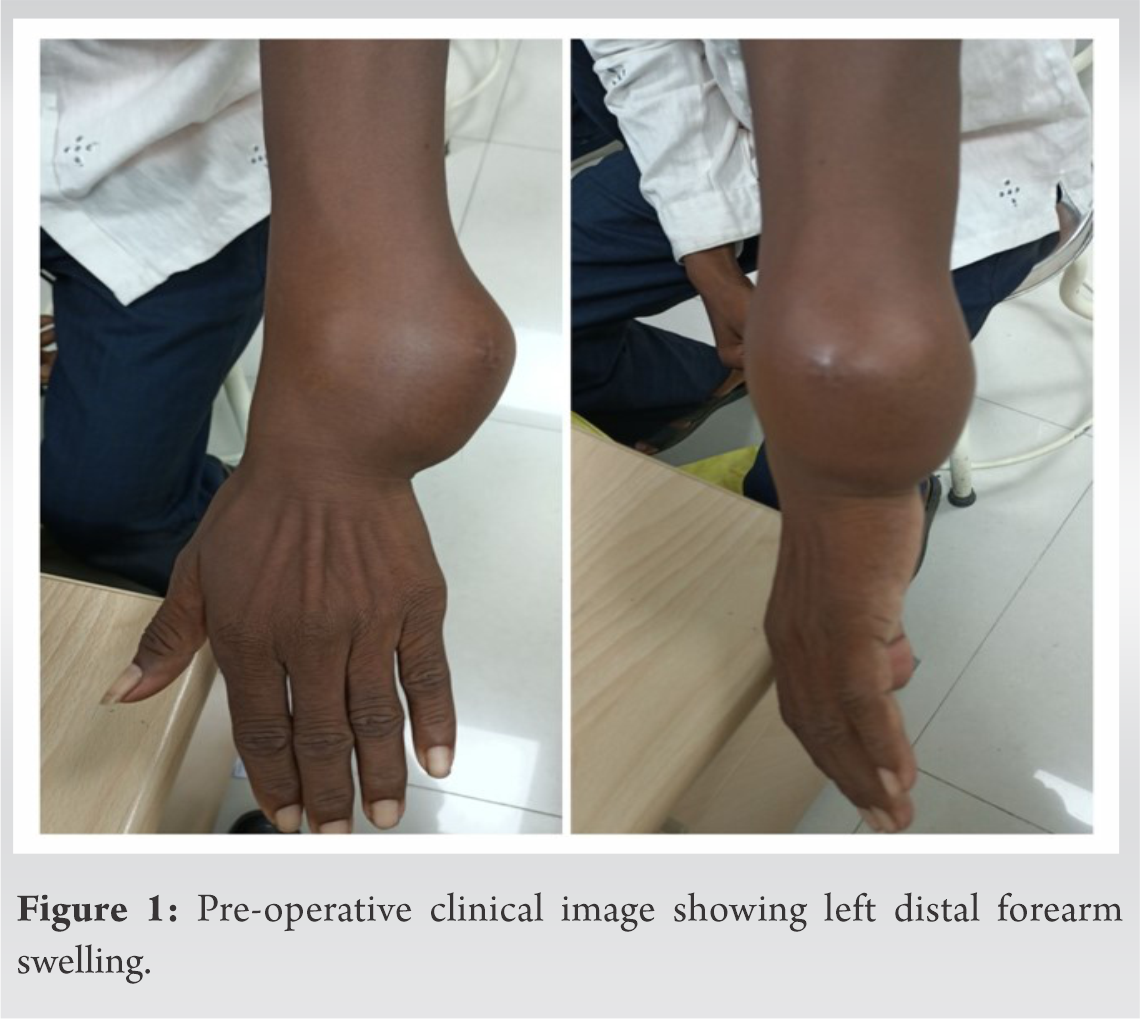 Huge Distal Ulna Giant Cell Tumor Treated with Wide Local Excision and ...
