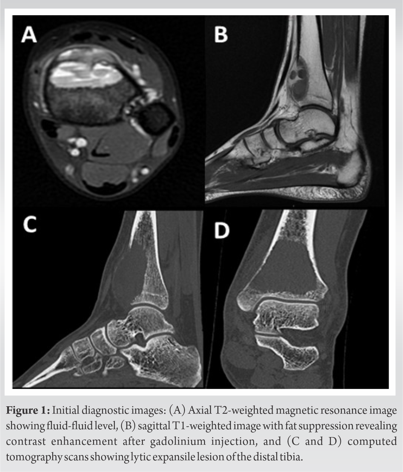 Response of Recurrent Aggressive Aneurysmal Bone Cyst of Distal Tibia ...