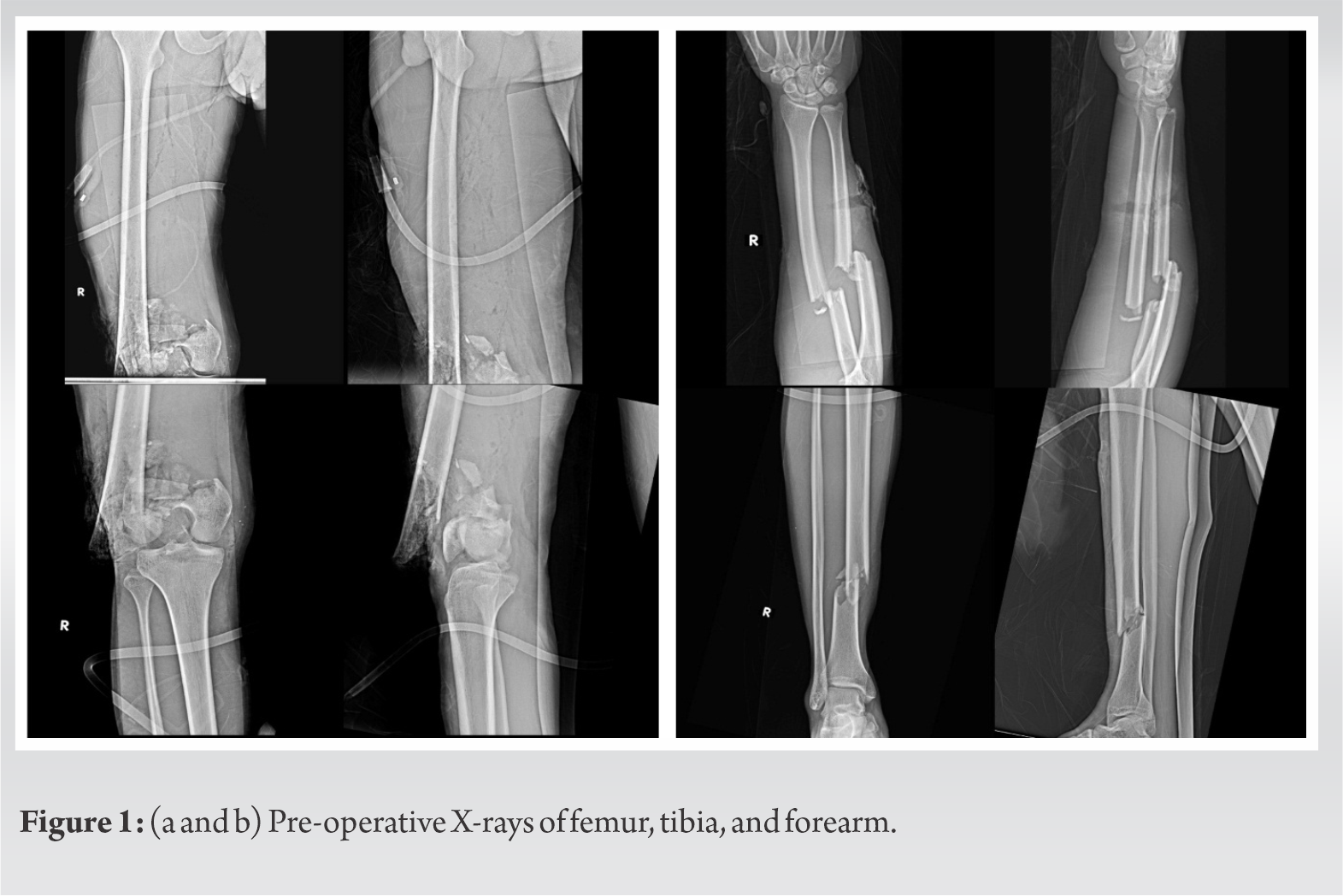 Management of Infected Gap Non-union of Distal Femur with Induced ...