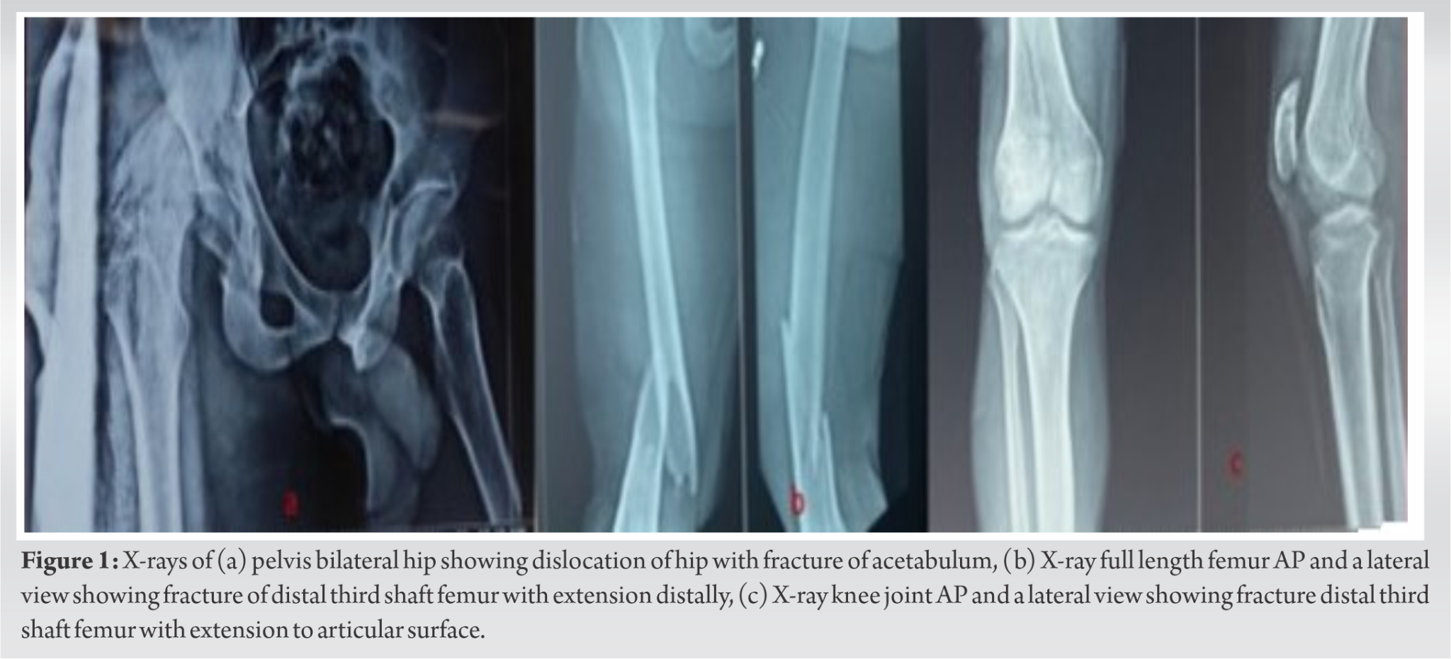 Clinical Outcome of Floating Hip with Irreducible Hip Dislocation and ...