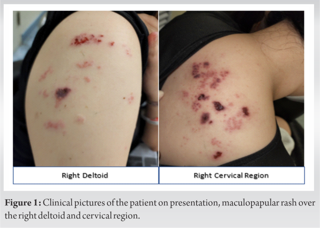 Case Report of Herpes Zoster Infection of the Cervical Dermatome – A ...