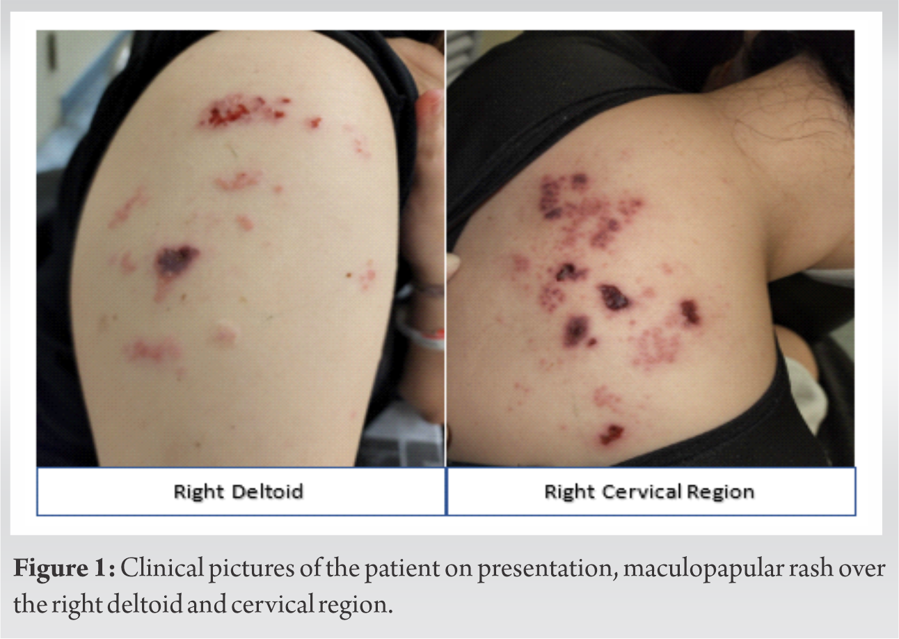 Case Report of Herpes Zoster Infection of the Cervical Dermatome – A ...
