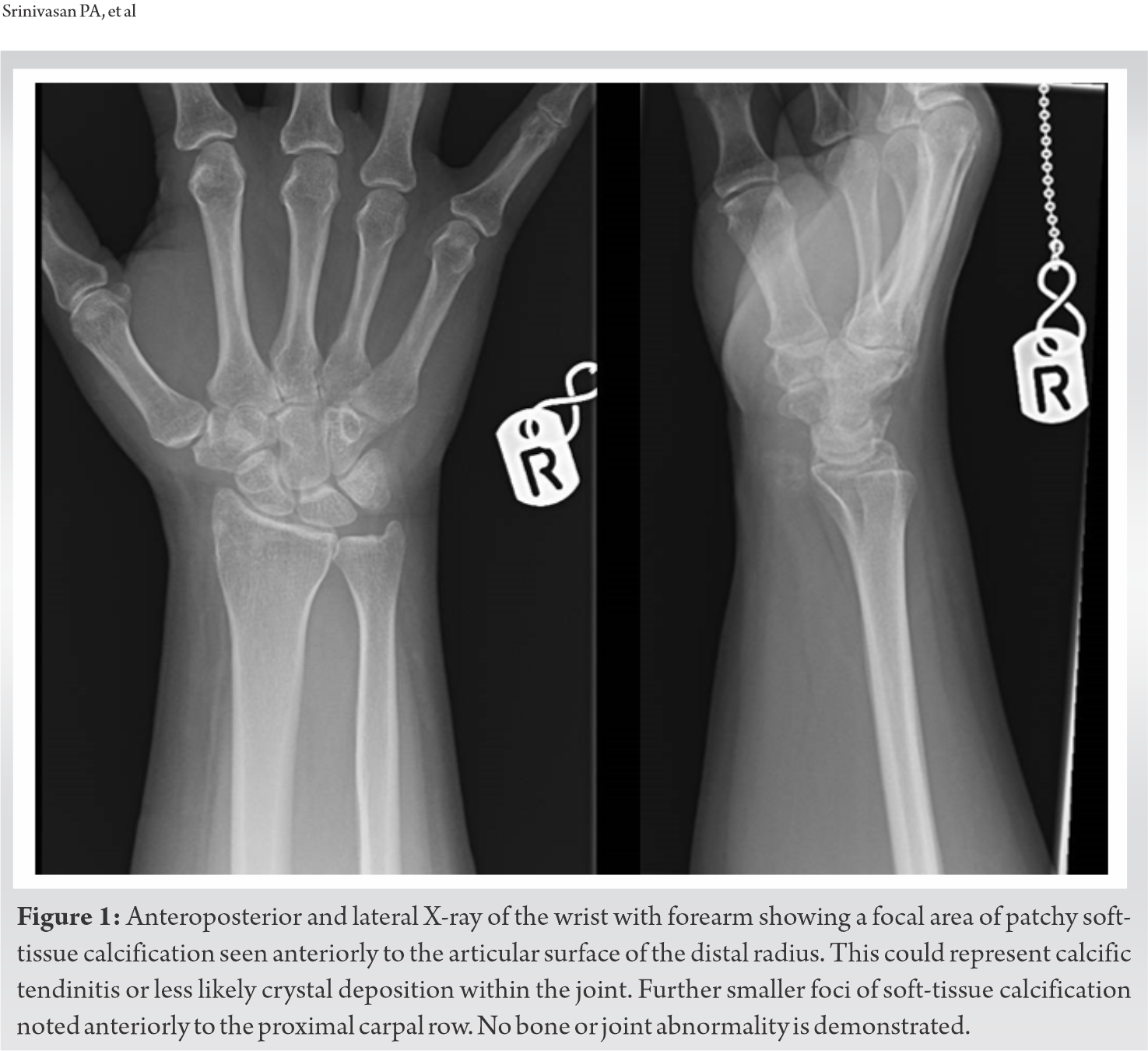 Uncommon Expression of Osteochondroma in the Wrist: A Case Report ...