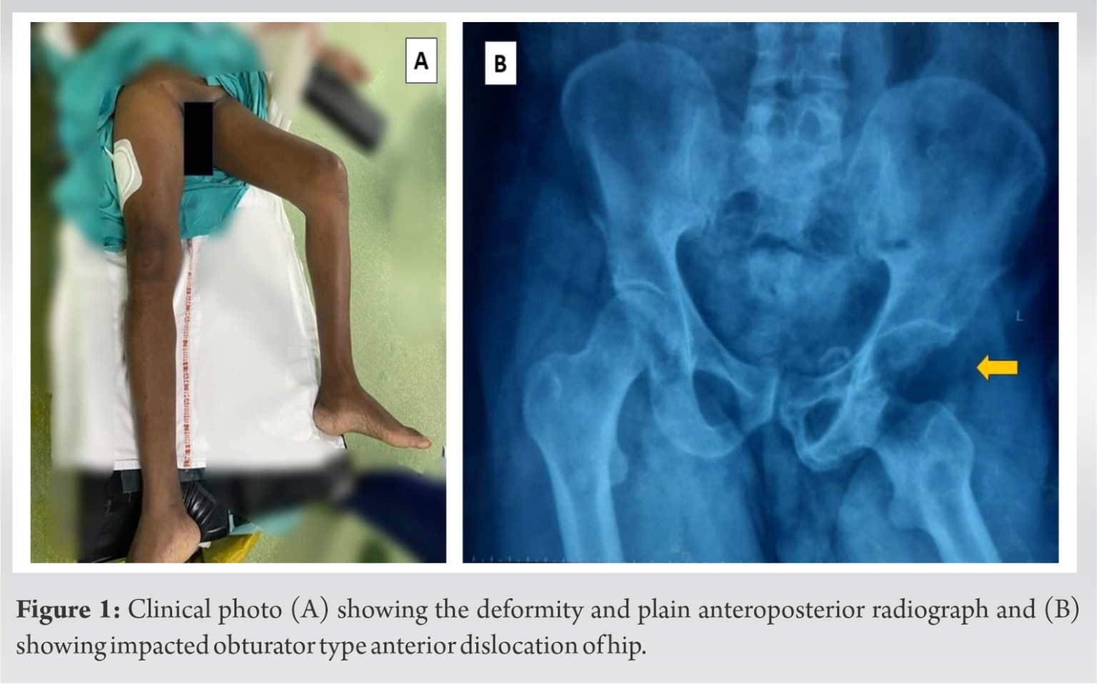 Neglected Anterior Dislocation of Hip Managed with Total Hip ...