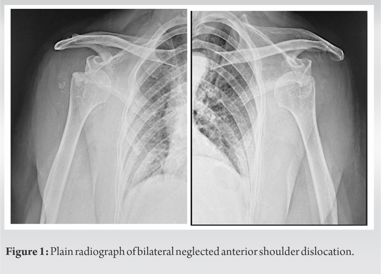 Management of Neglected Locked Anterior Shoulder Dislocation in the ...