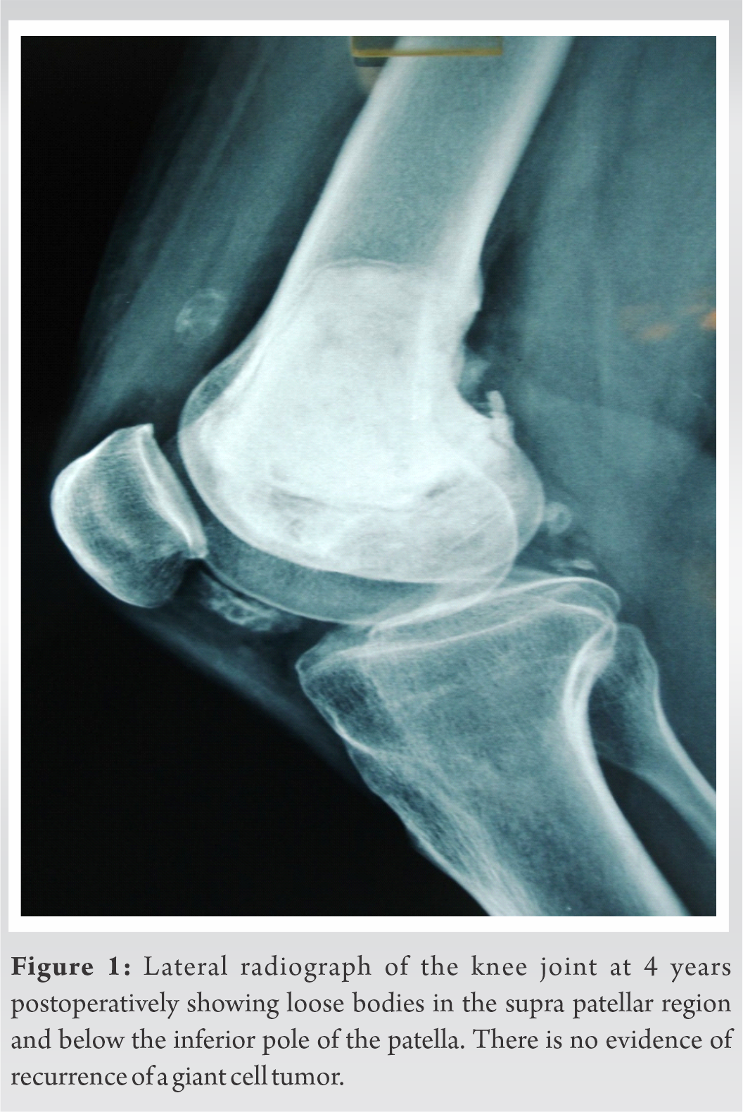 Giant Cell Tumor as a Rare Cause of Loose Bodies in the Knee Joint – A ...