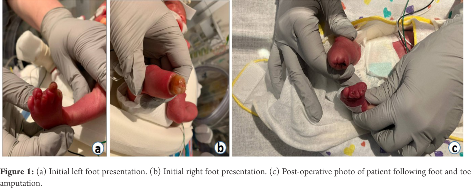 Club Foot with Contralateral Congenital Amniotic Band Syndrome ...