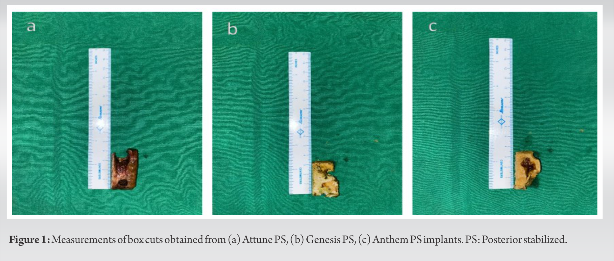 Bone Preservation in Femoral Intercondylar Box Cut – A Comparative ...