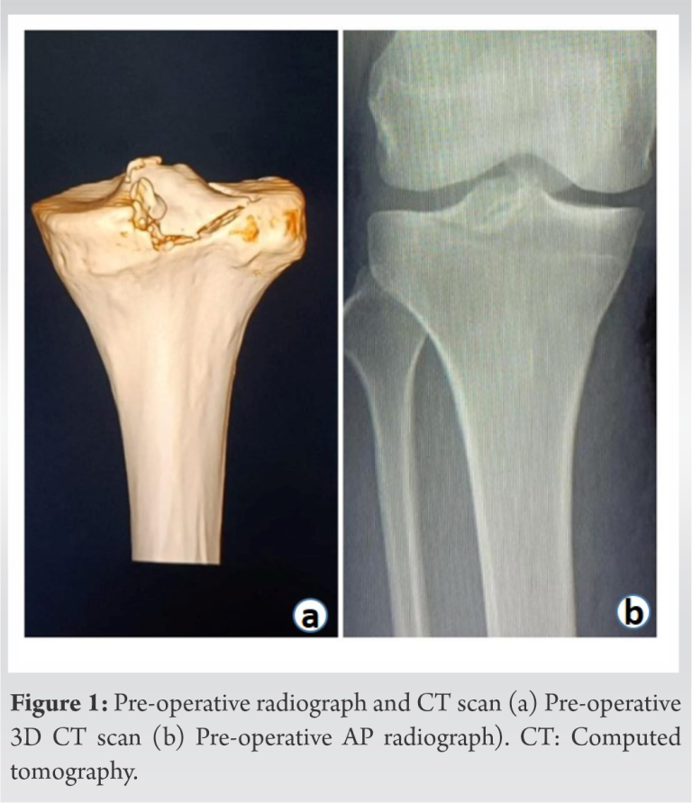Posterior Cruciate Ligament Avulsion Fracture of Tibia: Fixation with ...