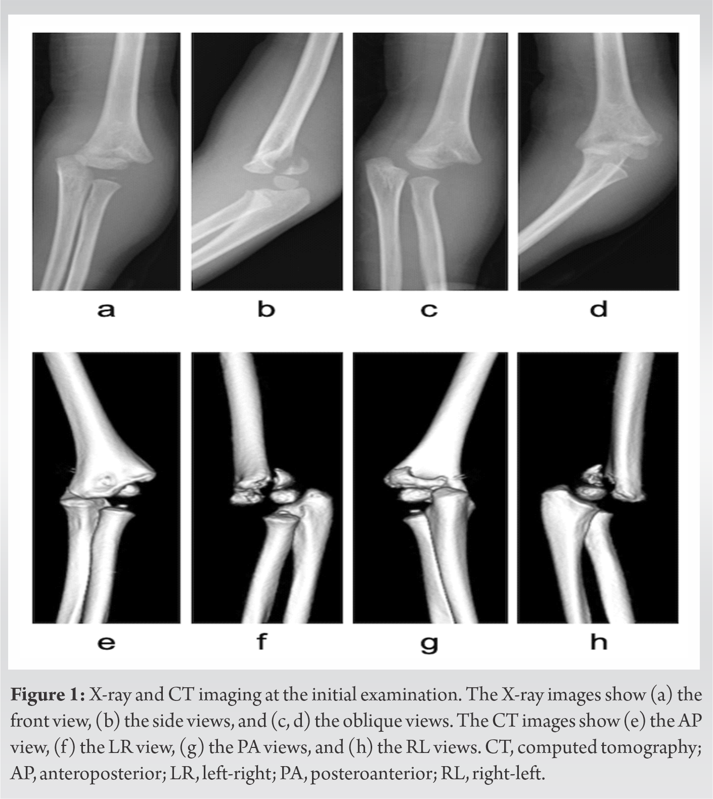 Case report: triplane fracture of distal humeral epiphysis diagnosed ...