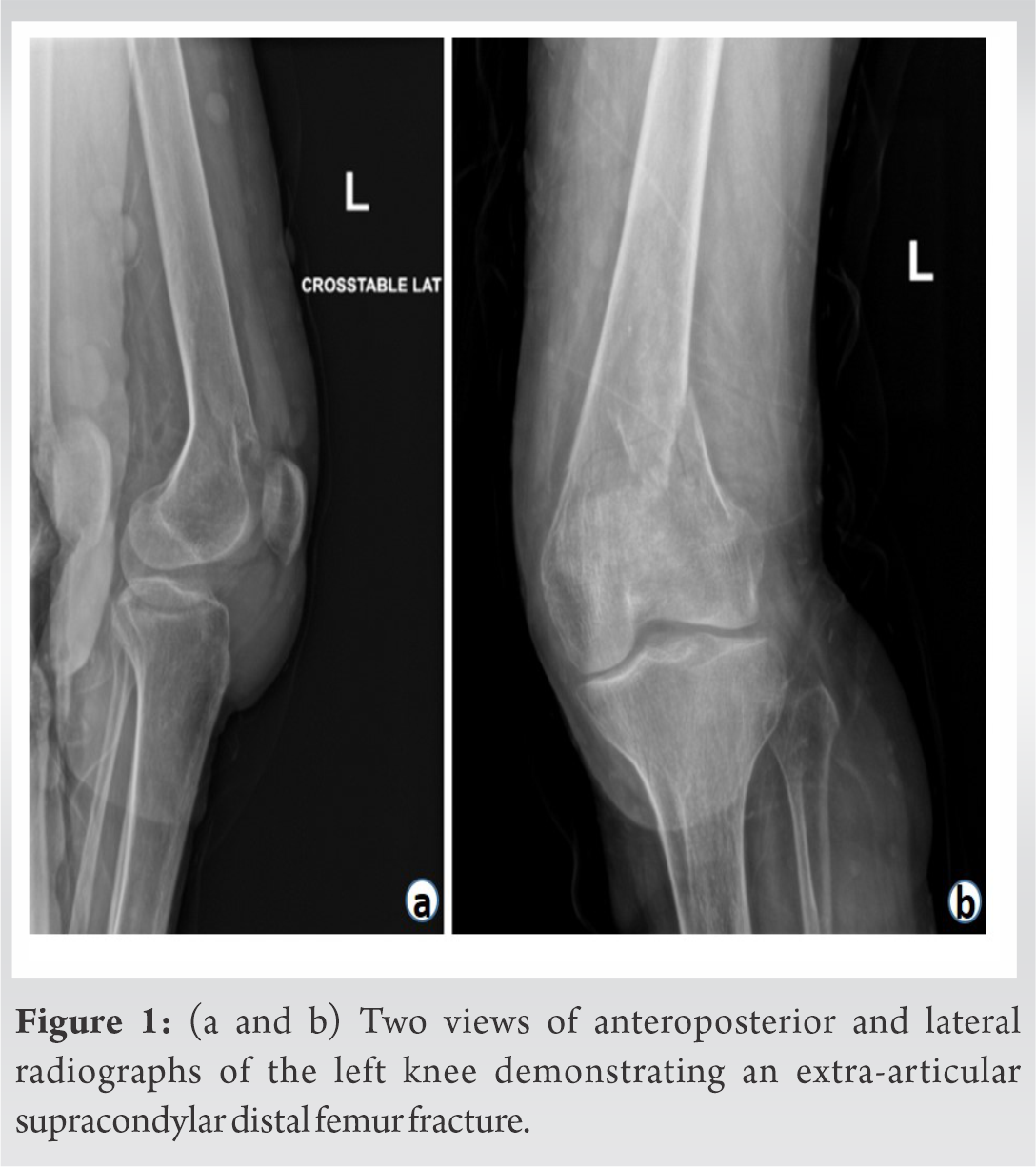 Intra-articular Knee Neurofibroma in a Patient with Neurofibromatosis ...