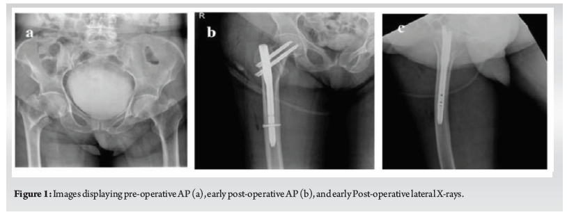 Pseudoaneurysm Formation in the Superior Gluteal Artery Following Short ...