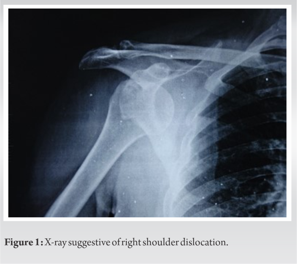 Recurrent Anterior Shoulder Dislocation with Coracoid Fracture in an ...