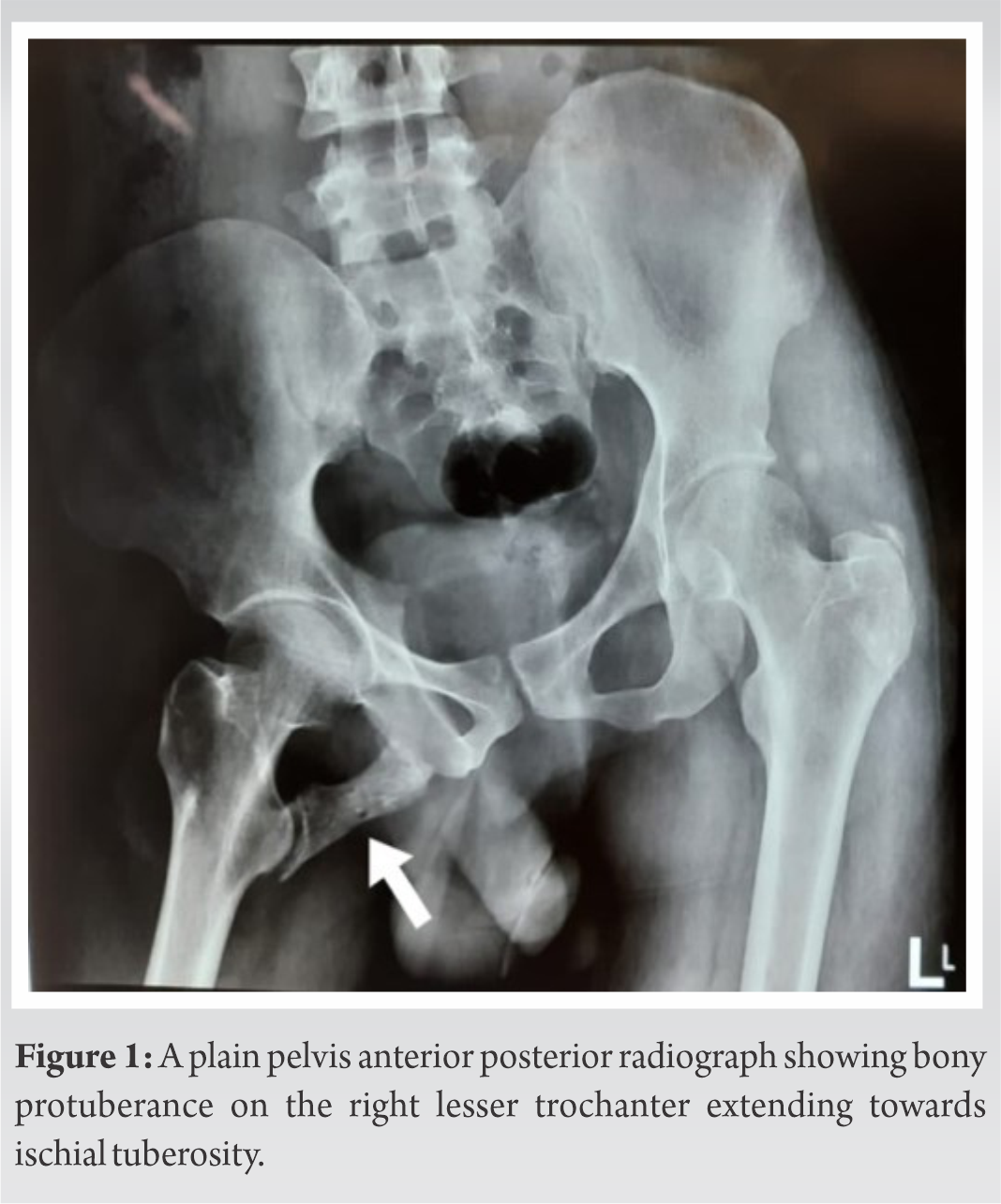 A Rare Symptomatic Pelvic Rib – A Case Report | Journal of Orthopaedic ...