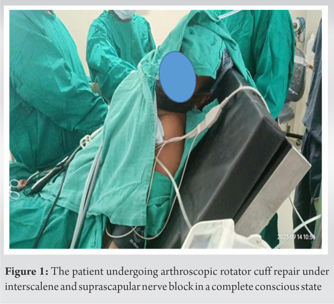 Shoulder Surgeries under Regional Anesthesia Approach and Outcome – A ...