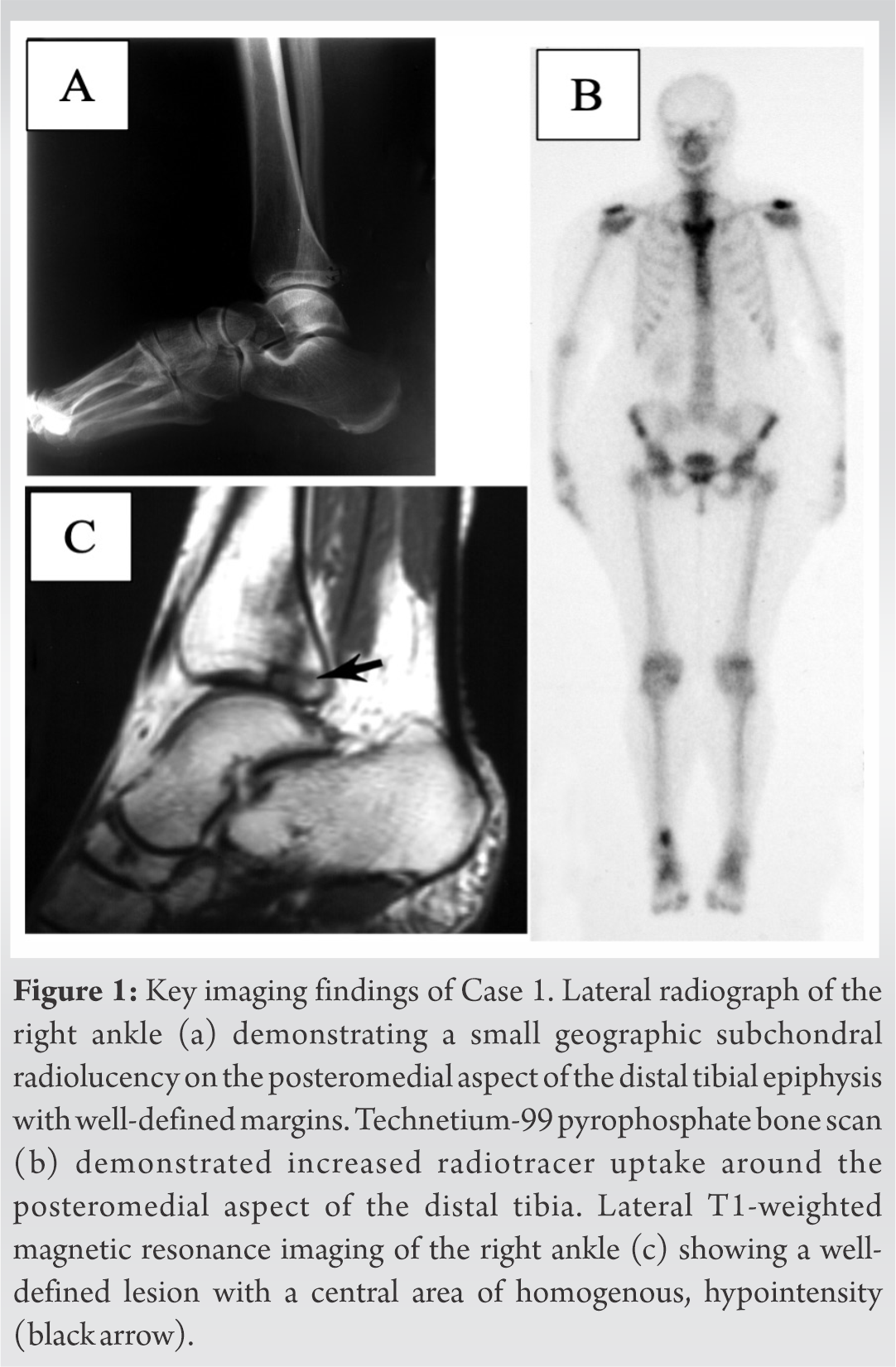 Brodie’s Abscess of the Ankle Presenting as a Tumor: A Summary of Five ...