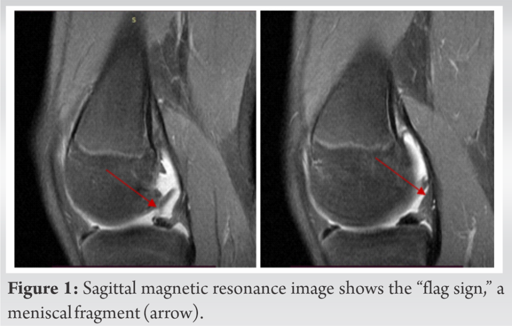 Flag Sign: A Case Report of an Unusual Magnetic Resonance Imaging ...