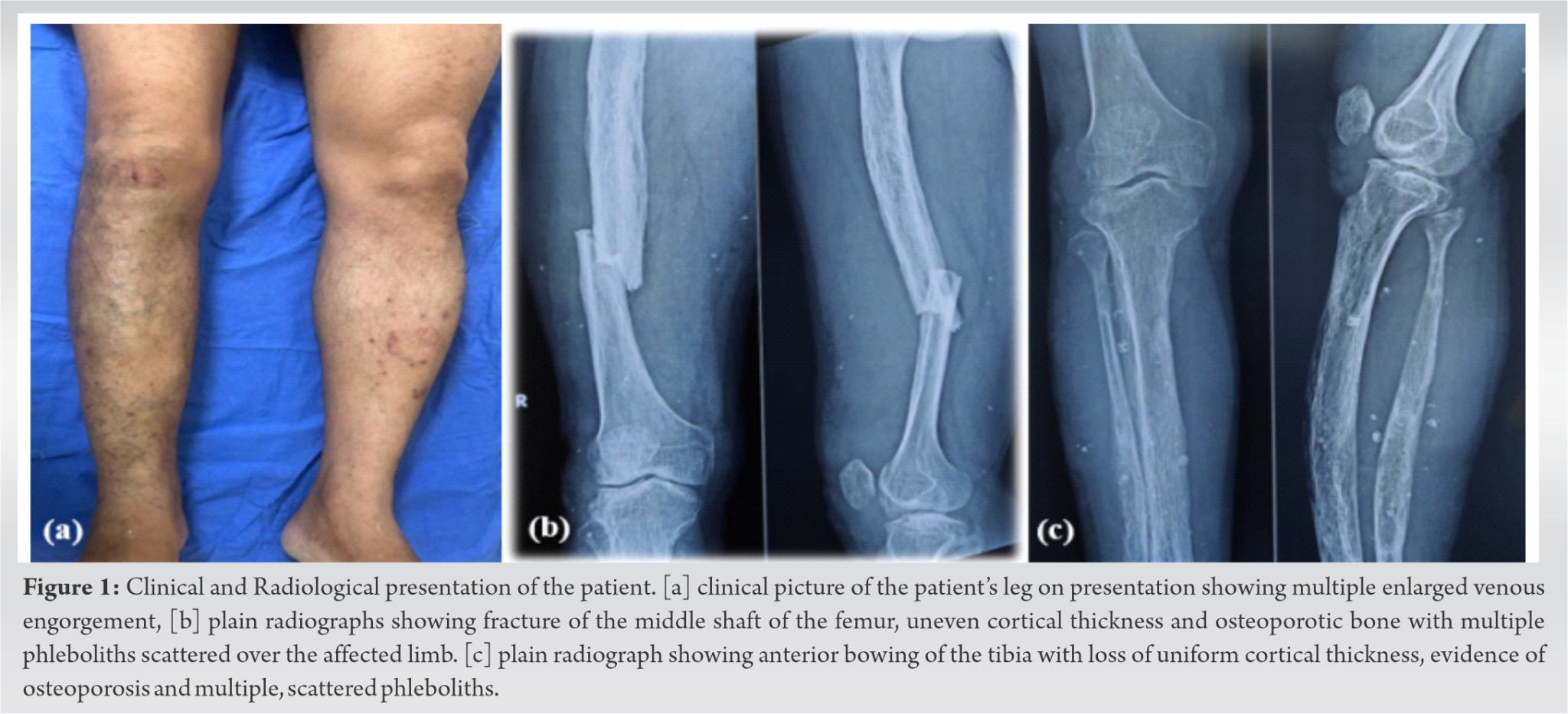 Femur Fracture in Klippel Trenaunay Syndrome: A Case Report | Journal ...