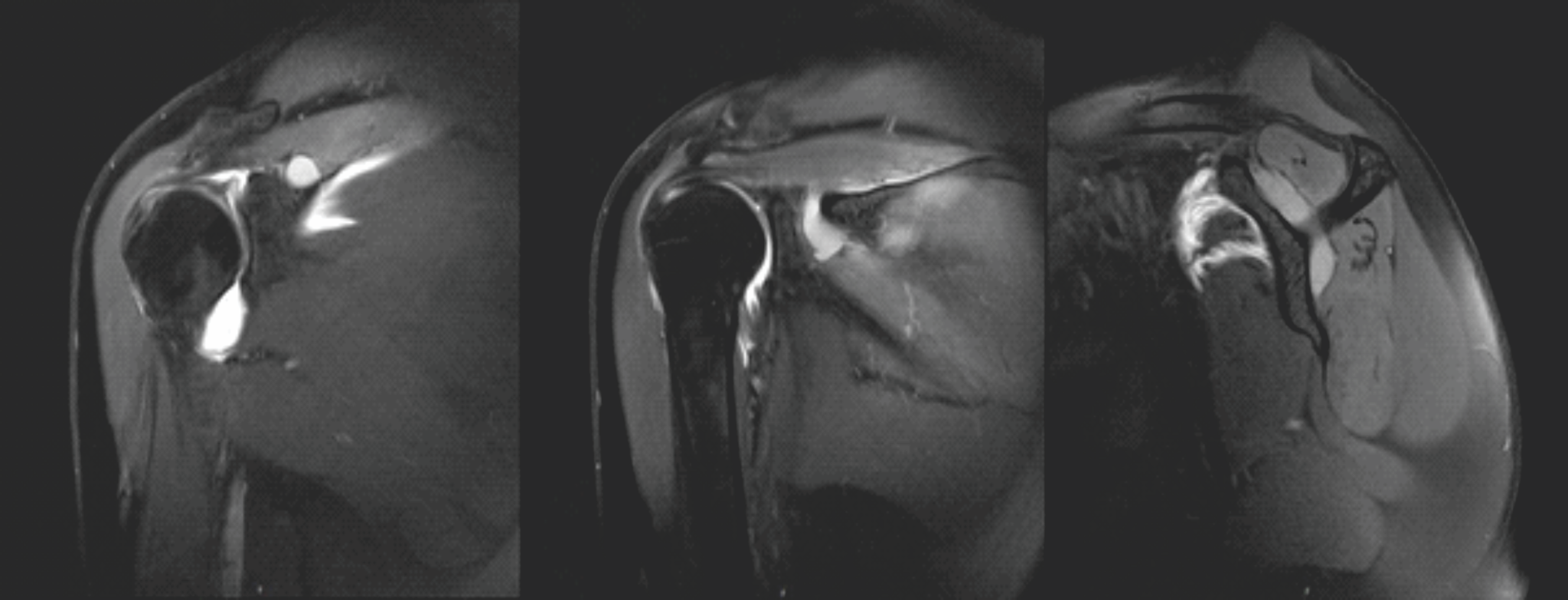 Intraneural Ganglion of the Suprascapular Nerve with Asymmetric Branch ...
