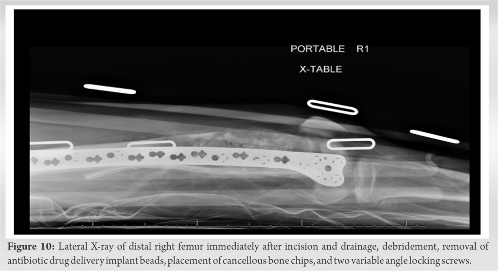 Operative Treatment of a Patient with a Pathological Fracture through a ...