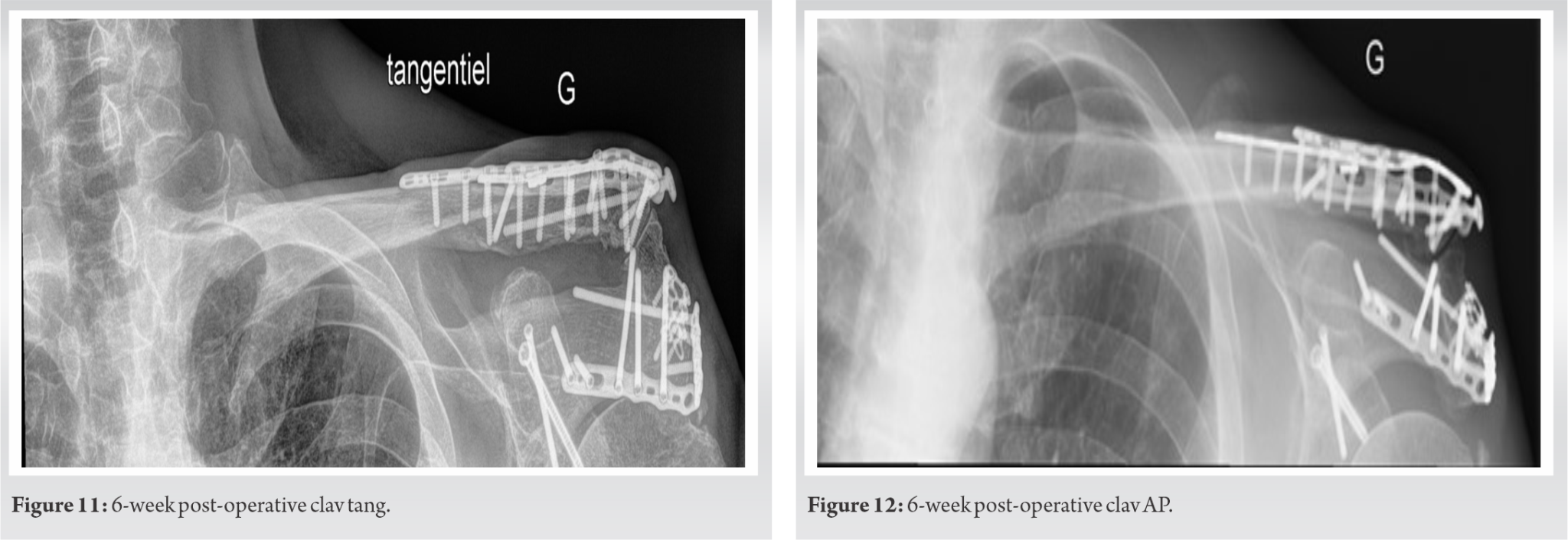 Triple Disruption of the Superior Shoulder Suspensory Complex: review ...