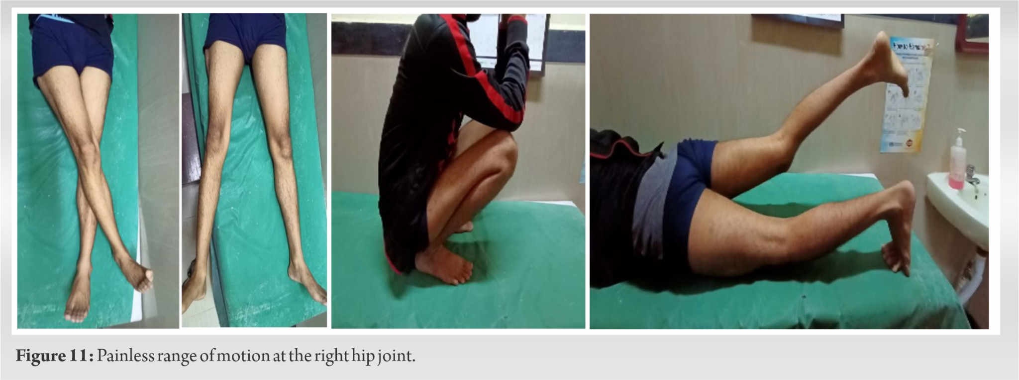 Management of Proximal Femur Aneurysmal Bone Cyst with 10-year Follow ...