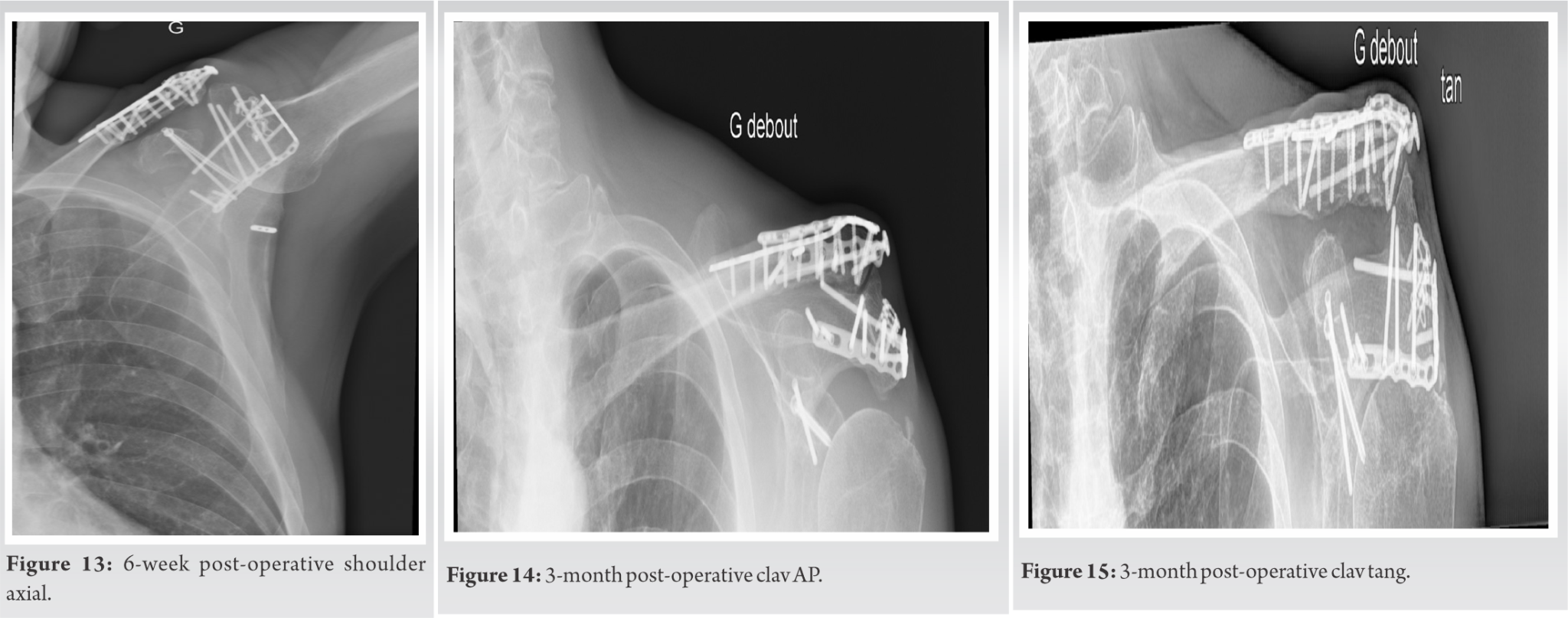 Triple Disruption of the Superior Shoulder Suspensory Complex: review ...