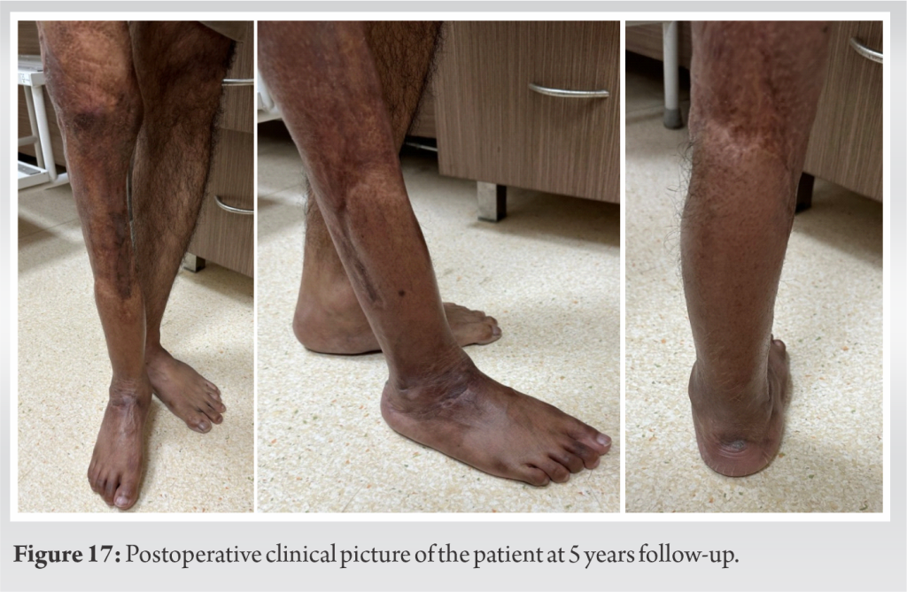 Lambrinudi Triple Arthrodesis with Posterior Tibial Tendon Transfer in ...