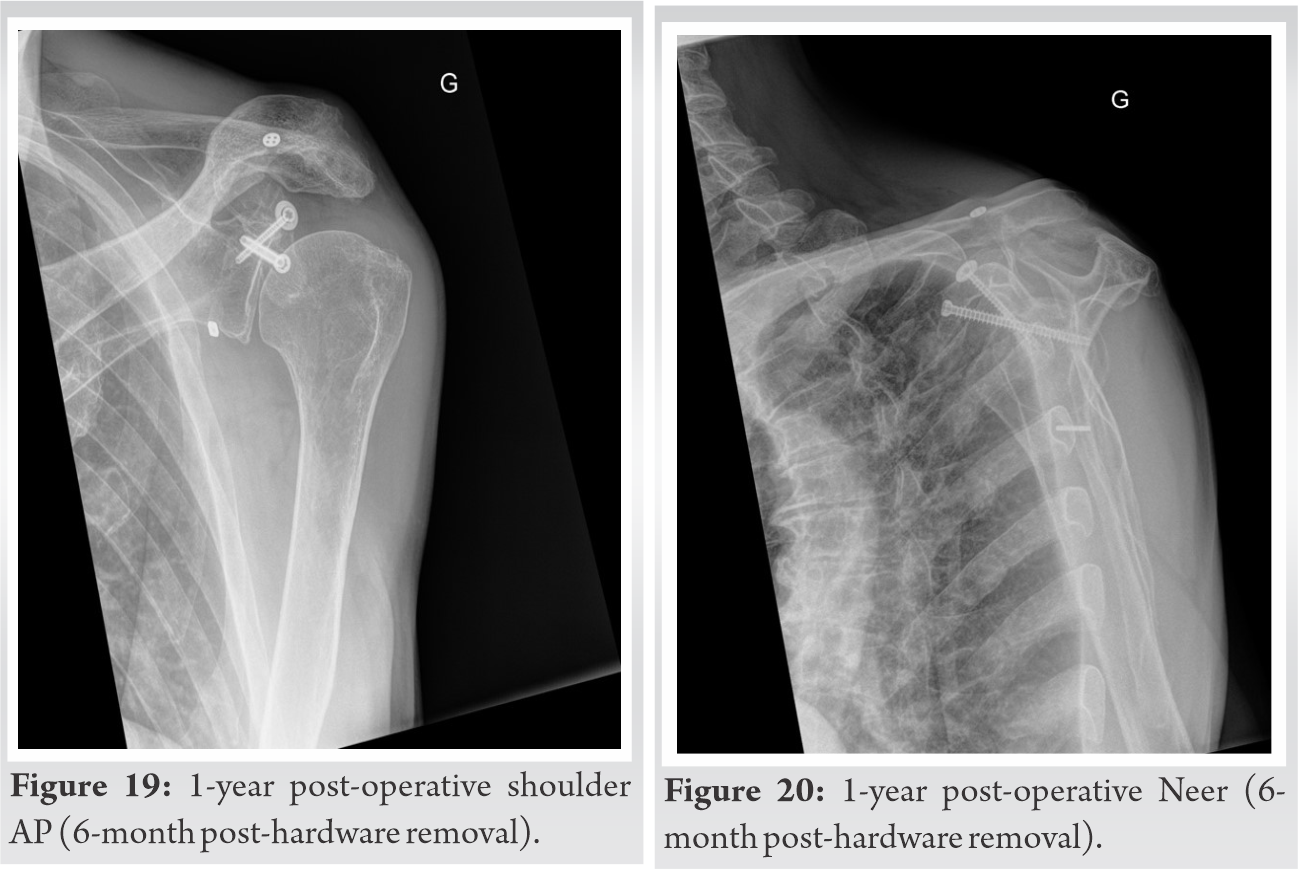 Triple Disruption of the Superior Shoulder Suspensory Complex: review ...