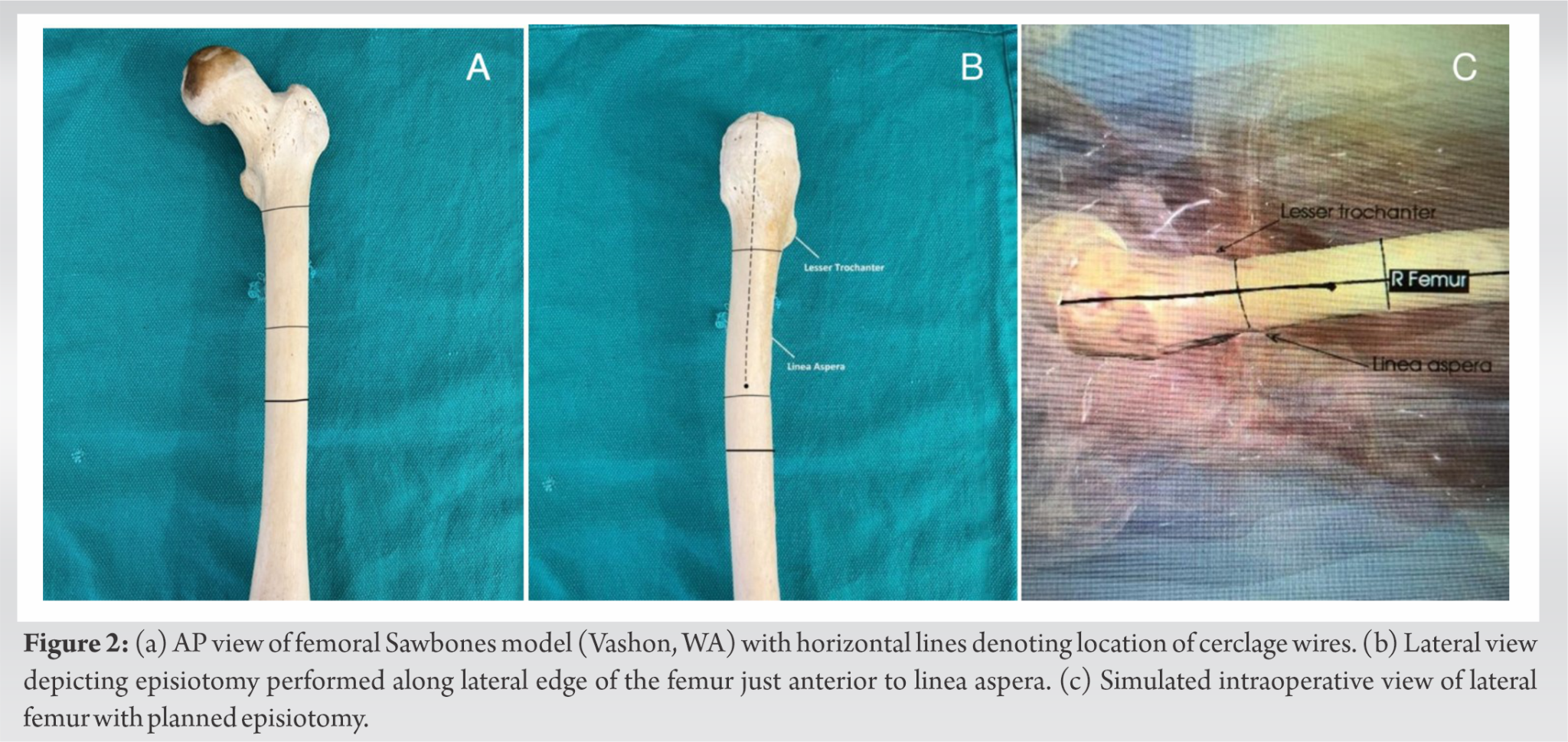 Episiotomy-assisted Incarcerated Femoral Nail Removal: Technical Note ...