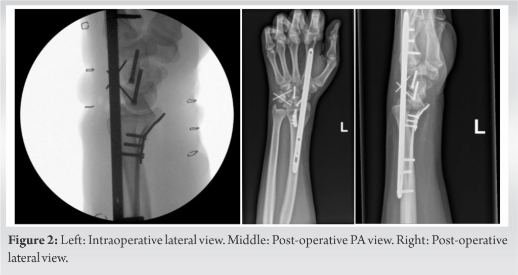 Transscaphoid Transcapitate Perilunate Fracture-dislocation with ...