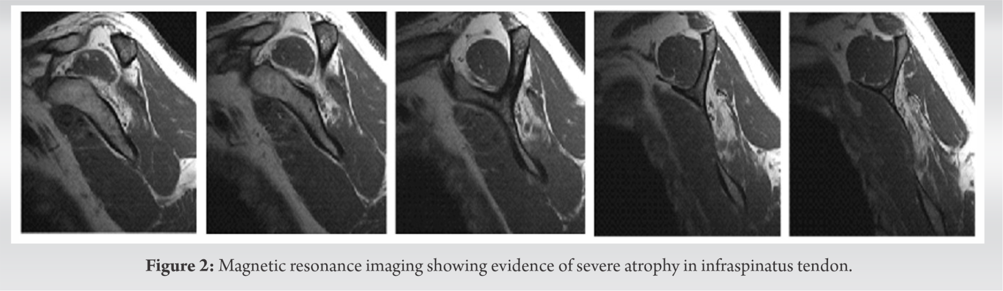 Effective Management of Bilateral Massive Irreparable Rotator Cuff ...