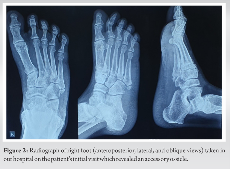 Red Herring in Orthopedics: A Case Report on Painful Os Vesalianum ...