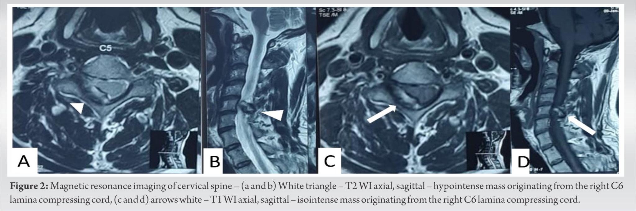 O-arm Navigated en bloc Excision of a Solitary Subaxial Cervical ...