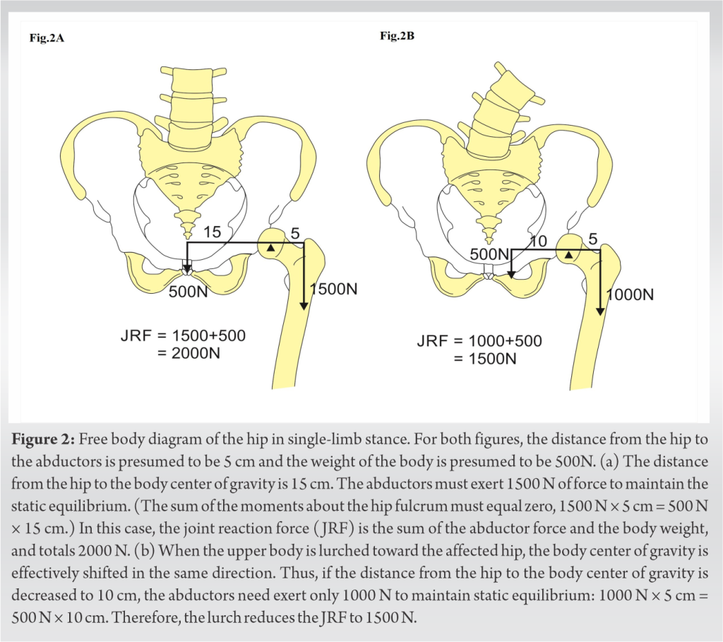 Analysis of Limp, Lurch, and List in Spinal Afflictions – What is the ...