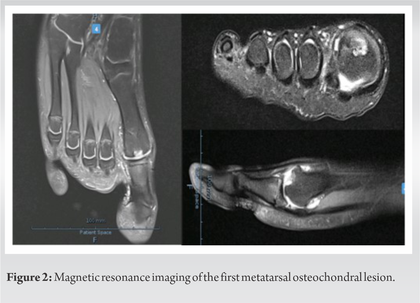 Case Report of an Osteochondral Lesion of the First Metatarsal Head in ...