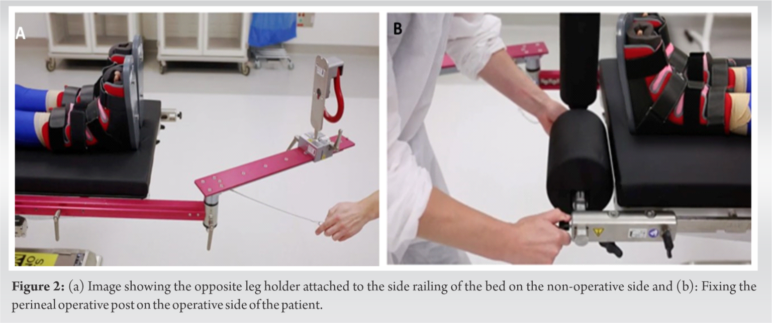 Surgical Technique of Direct Anterior Approach for Primary Total Hip ...